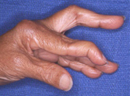 Swan Neck Deformity - Hand - Orthobullets